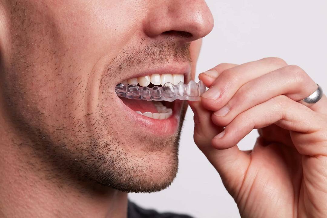 How Long Do Clear Aligners Take to Work? Understanding Your Treatment Timeline – ODONTO Clear ...