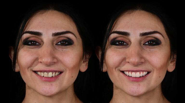 Using Smile Simulation Software to Increase Case Acceptance – ODONTO ...